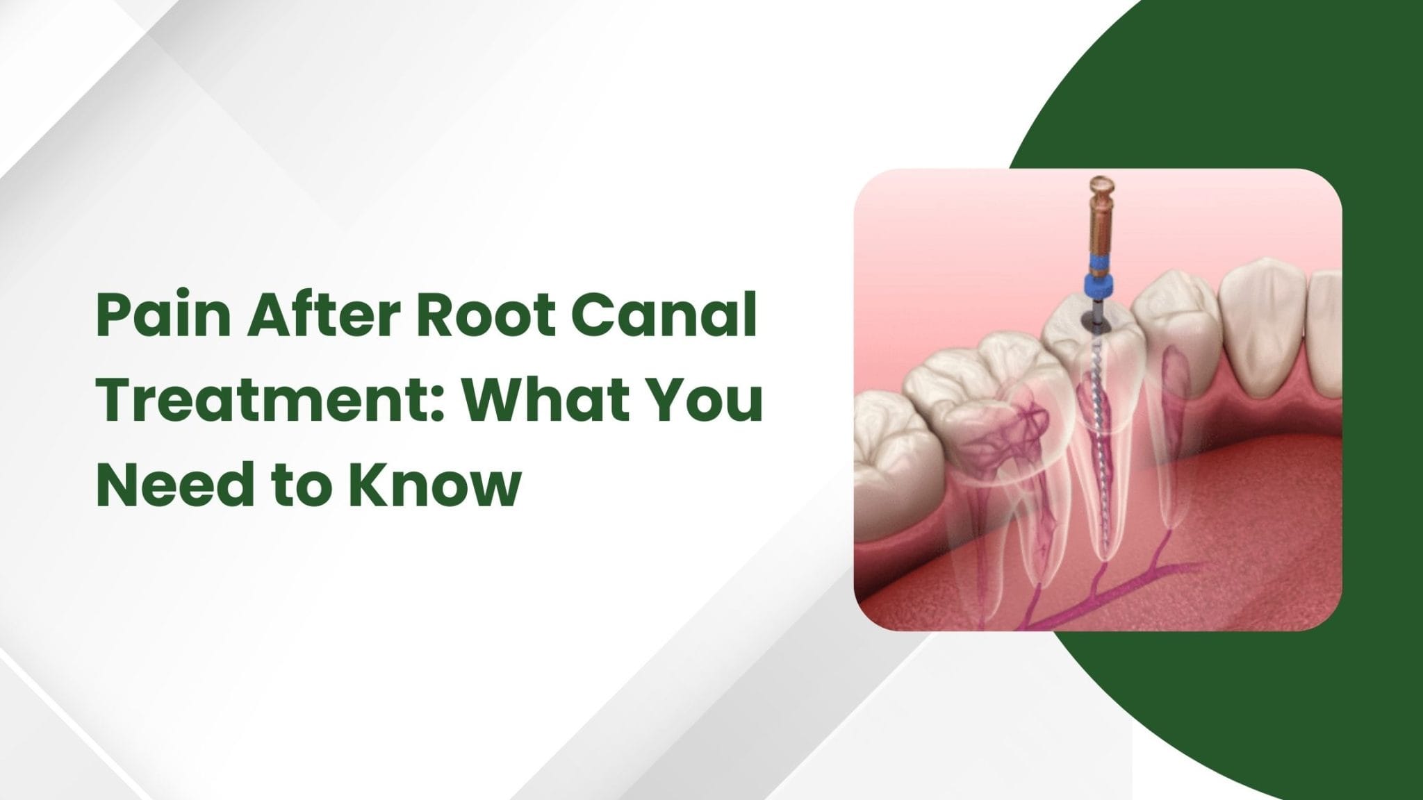 Pain After Root Canal Treatment | GuGu Dental Clinics